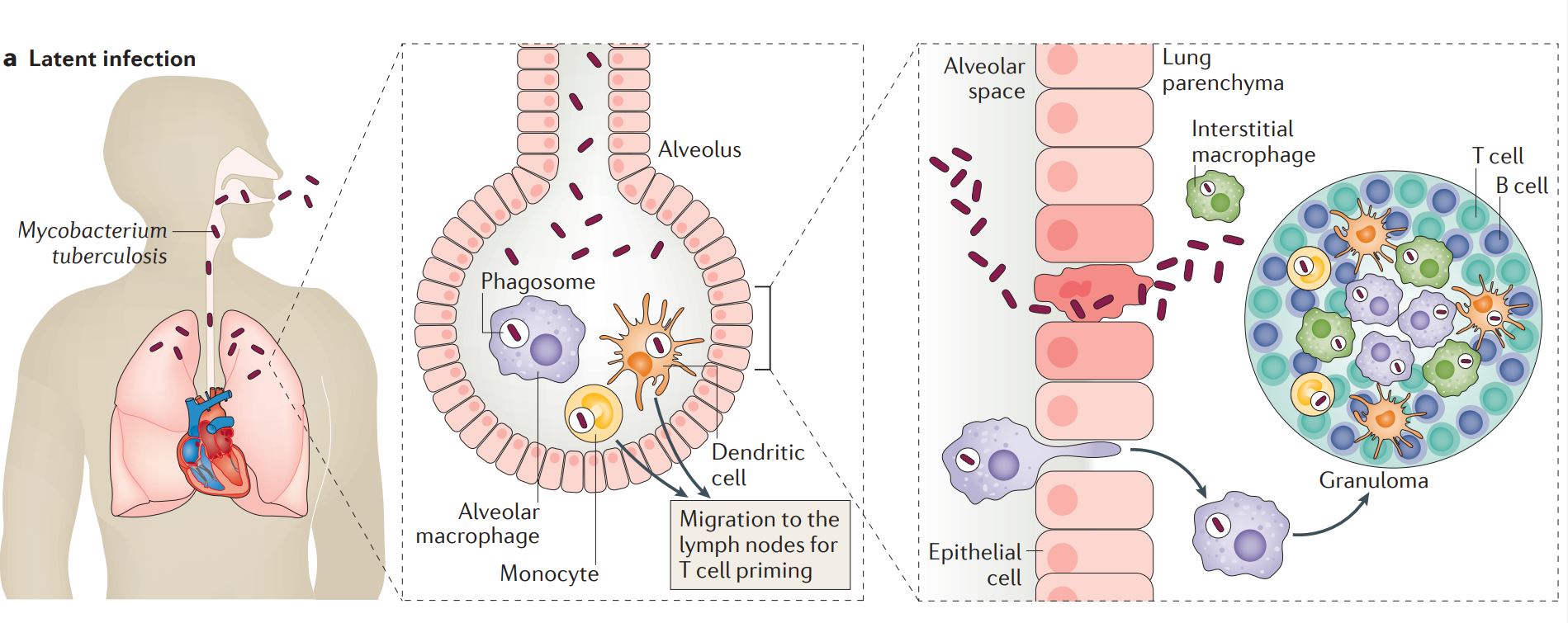 Innovative TB Diagnostics using universal Lateral Flow